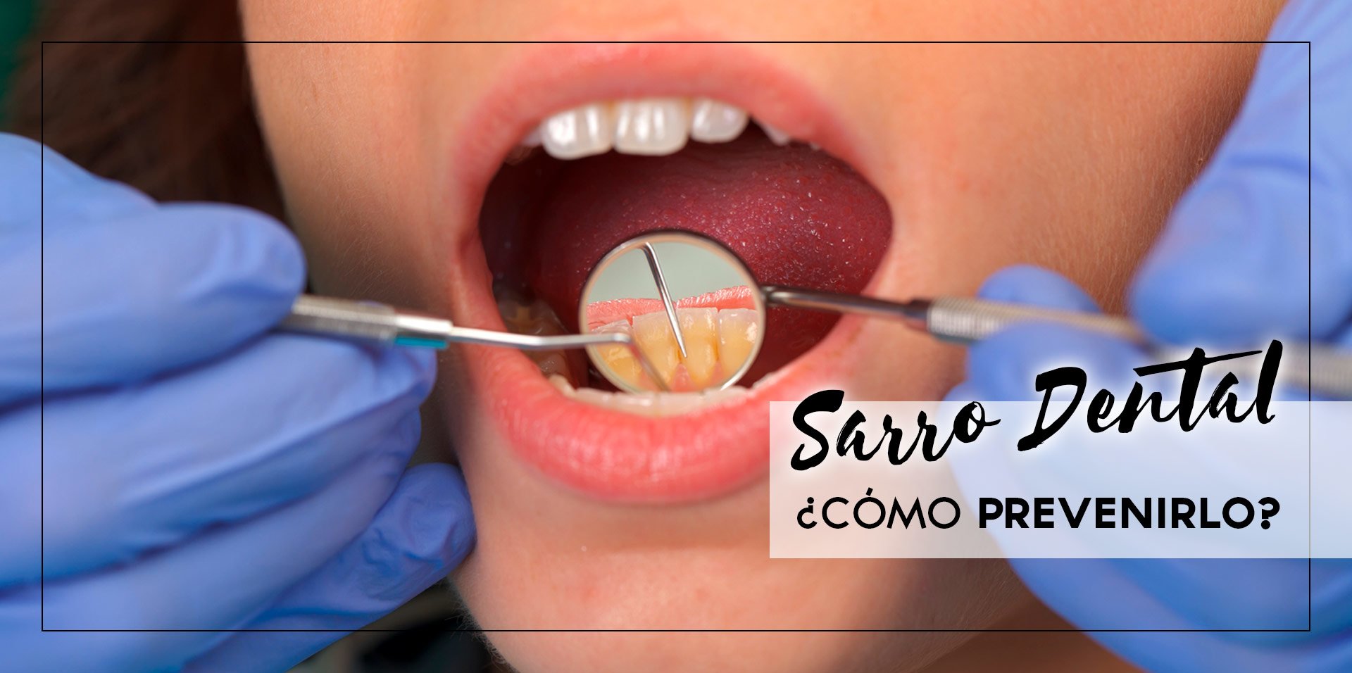 Como Se Produce Y Como Prevenir El Sarro Dental • CLÍNICA LOOK DENTAL