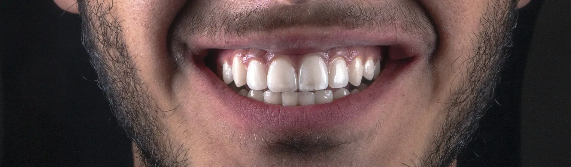 El Color Natural De Los Dientes • CLÍNICA LOOK DENTAL